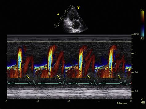 Pulsed Wave Doppler Mitral Valve