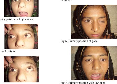 Medical Term Double Elevator Palsy At Stuart Witt Blog