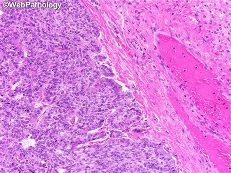 Metastatic Neuroendocrine Tumor