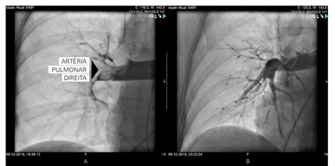 Angiografia Da Artéria Pulmonar Direita Seta Antes A E Depois B