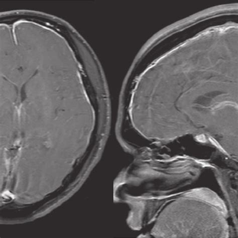 Gadolinium Enhanced Brain Mri T2 Weighted Images In Sagittal Plane Download Scientific Diagram