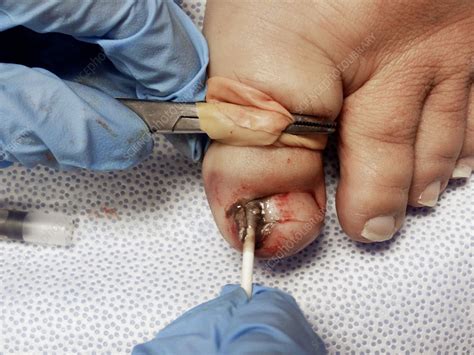 Ingrown Toenail Surgery Stock Image C0599571 Science Photo Library