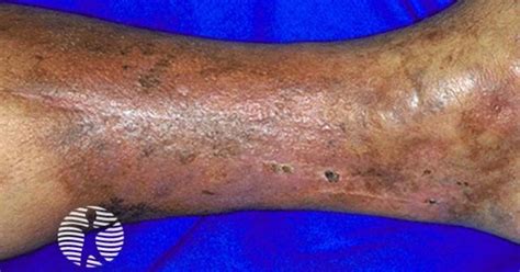 Lipodermatosclerosis Image