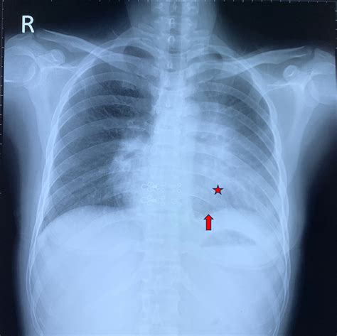 Chest X Ray Of The Patient The Image Reveals A Heterogeneous Opacity Download Scientific
