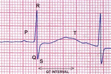 Long QT Syndrome NHS