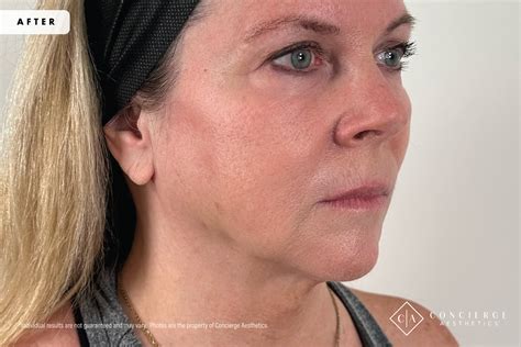 B A Juvederm Voluma Cheeks Chin And Jawline