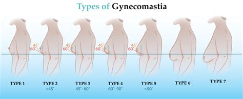 Gynecomastia Turkey Prices 2024 Clinicplast