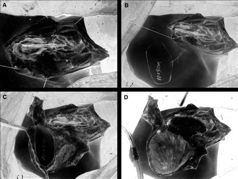 Stricture Resection And Reconstruction Of The Esophageal Defect Using A