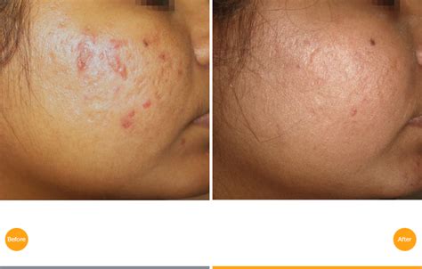 Acne Scars Skinqure