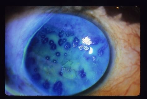 Cornea Toxicity Propine Retina Image Bank