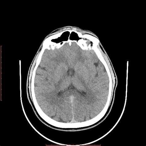 Radiopaedia Case Developmental Venous Anomaly Id 50683 Study 56125