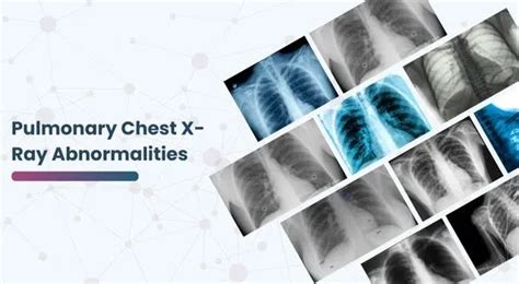 pulmonary chest x ray abnormalities gts
