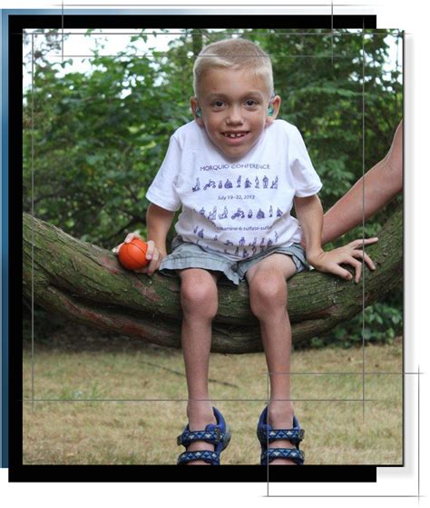 Types Of Dwarfism — Understanding Dwarfism