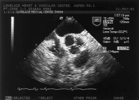 Crista Terminalis Echo