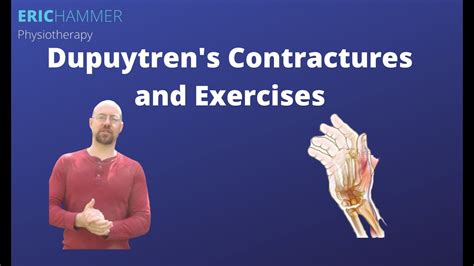 Dupuytrens Contractures And Exercises Youtube