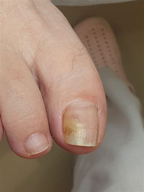 Онихолизис ногтей диагностика лечение профилактика Подолог в Симферополе вросший ноготь