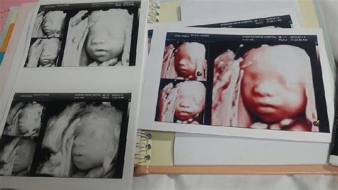 임신 25주 임당검사와 입체 초음파 네이버 블로그