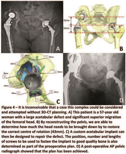 3d Ct A Better Map For Hip Surgery Medicad 3d Ct A Better Map For Hip Surgery Medicad
