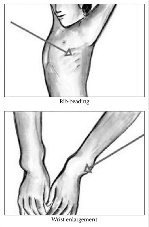 Clinical Features Of Rickets Clinical Features Of Rickets Download