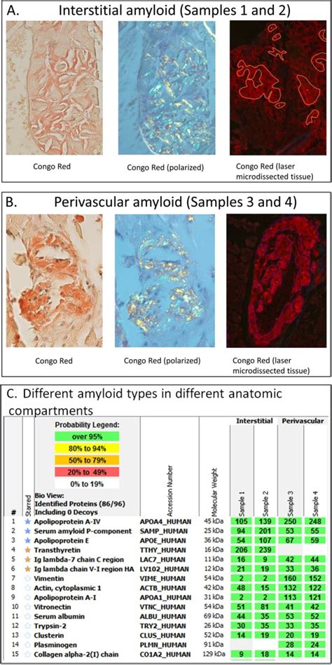 Two Types Of Amyloidosis Presenting In A Single Patient A Case Series