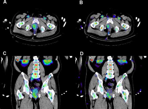The Effect Of Deconvolution Based Partial Volume Error Correction On