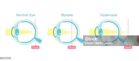 Vector Illustration Of Normal Vision And Myopia And Hyperopia Stock Illustration Download