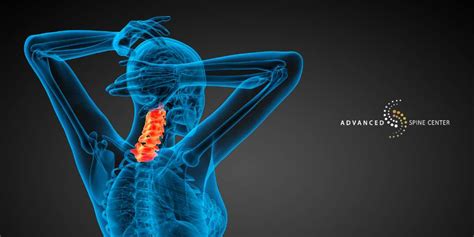 Hemilaminectomy Surgery In Plano Tx Advanced Spine Center