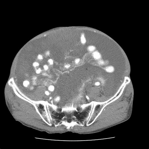 Appendix Neoplasm 1426 Jelly Belly Surgery Photos