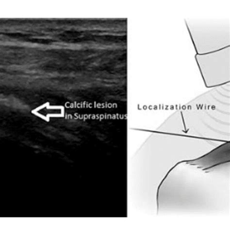 Ultrasound Of Localization Wire Entering Calcific Lesion On Left And Download Scientific