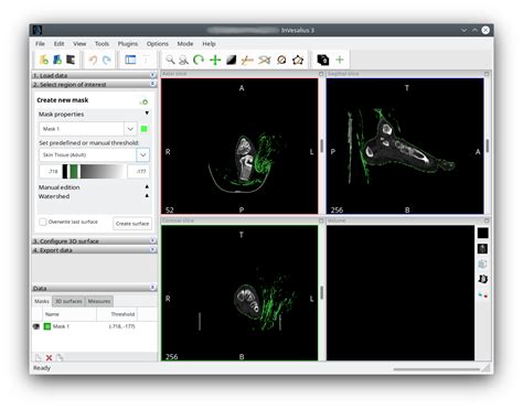 3d Printed Toe Splint
