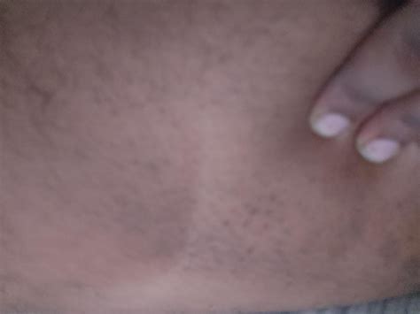 What Is This In My Inner Thigh Rdermatologyquestions