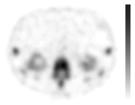 Transaxial Slice Of Skeletal Spect A Autoregressive Filtering Before Download Scientific