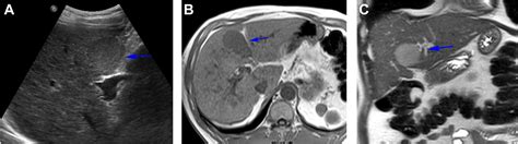 Imaging Of Hepatic Segment 4 Advances In Clinical Radiology