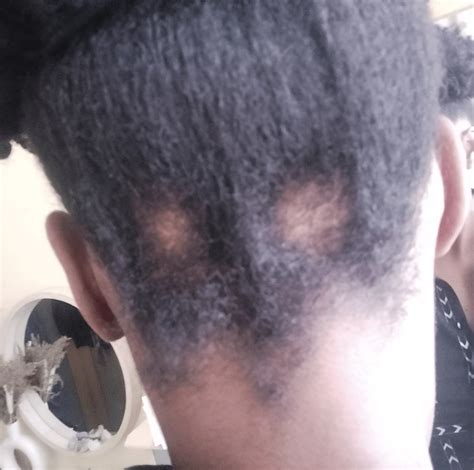 Bald Patches R Naturalhair
