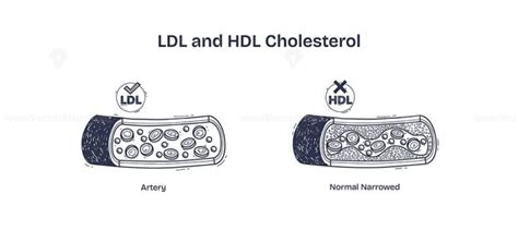 Ldl And Hdl Cholesterol Diagram Shows Artery Health Key Objects Ldl Hdl Artery Diagram