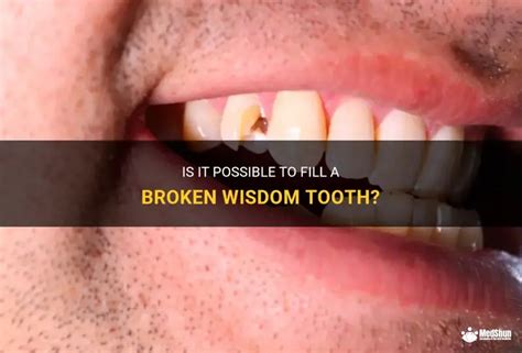 Is It Possible To Fill A Broken Wisdom Tooth Medshun