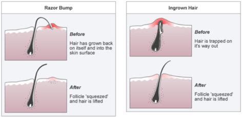 How To Prevent Ingrown Hairs After Shaving 12 Ways