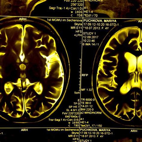 MRI Of The Brain In Dynamics Marked Atrophic Changes In The Brain Download Scientific Diagram