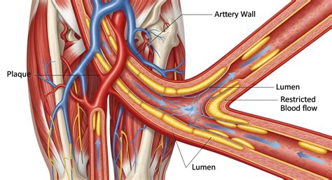 Peripheral Artery Disease Symptoms And Treatment Options