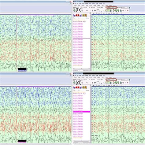 quantitative eeg analysis a before the iv methylprednisolone