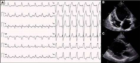 Left Bundle Branch Block As A Marker Of Unlikely Left Ventricle Reverse Download Scientific