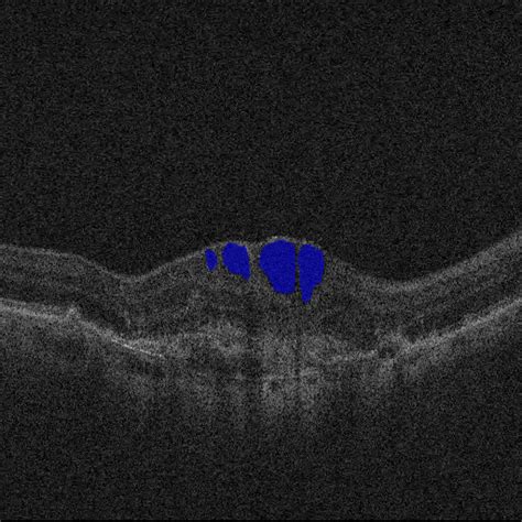 Sd Oct B Scan Examples In Optima Challenge Dataset With Intraretinal