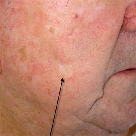 White Mole On Face