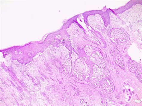 Superficial Basal Cell Carcinoma Histology