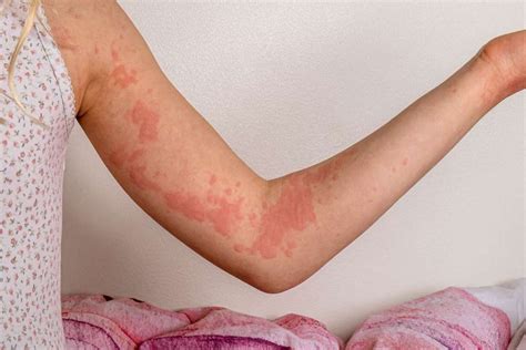 Types Of Skin Rash Diseases Causes Symptoms And Common Conditions