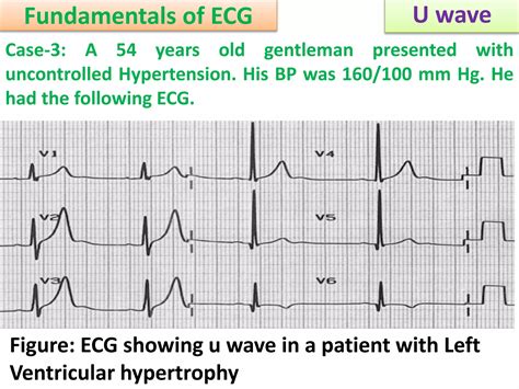 Approach To A Patient With U Wave In Ecg Ppsx