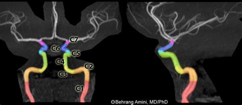 Radiopaedia Internal Carotid Artery Segments At John Hipple Blog