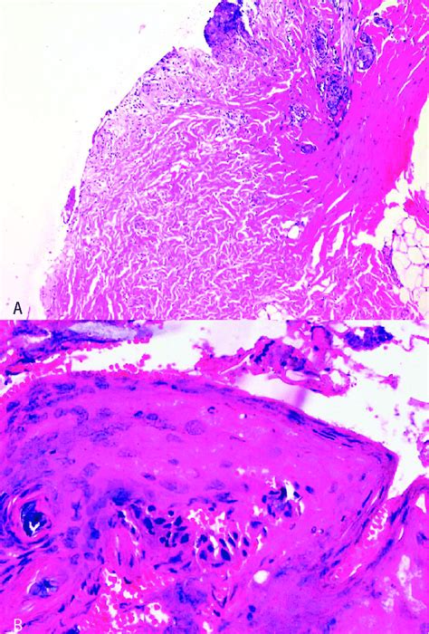 A Section Showing Exposed Dermis With A Mild Mononuclear Inflammatory
