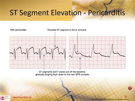 Ppt Myocardial Ischemia Injury And Infarction Powerpoint