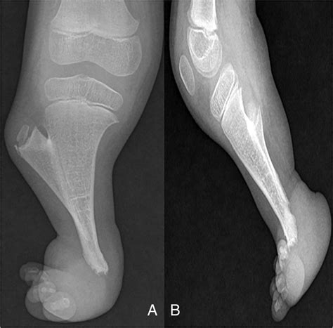 Fibular Hemimelia Amputation